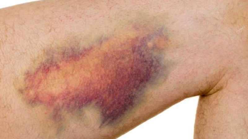 Hematom Nedir? - Son Dakika Adana Haberleri